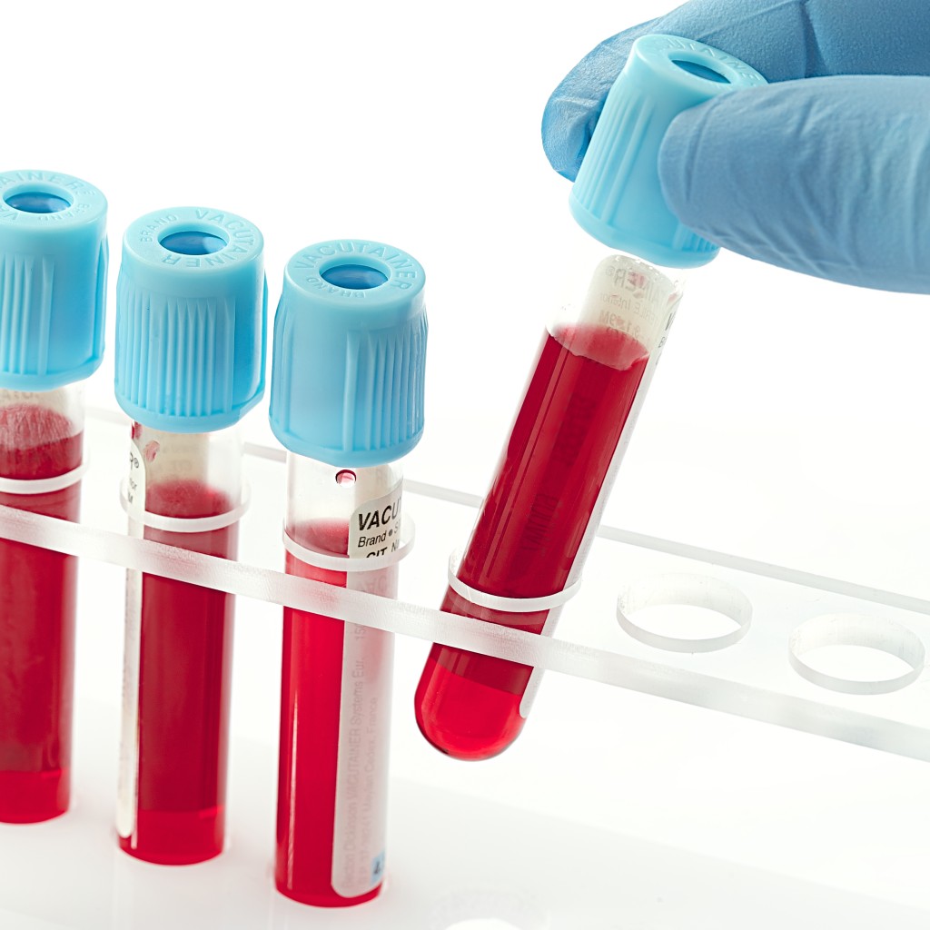 New Potential Serum Biomarker for Interstitial Lung Disease Associated ...