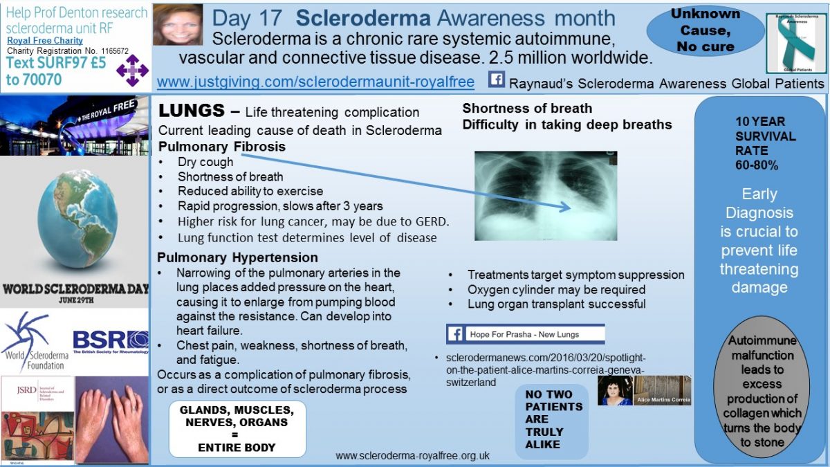DAY 17 Scleroderma Awareness Month: THE LUNGS | Scleroderma News