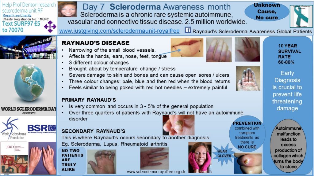 DAY 7 Scleroderma Awareness Month - RAYNAUD'S | Scleroderma News