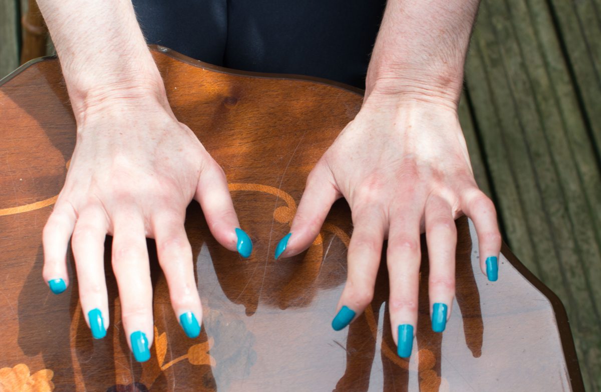 DAY 9 Scleroderma Awareness Month - DIGITAL ULCERS | Scleroderma News