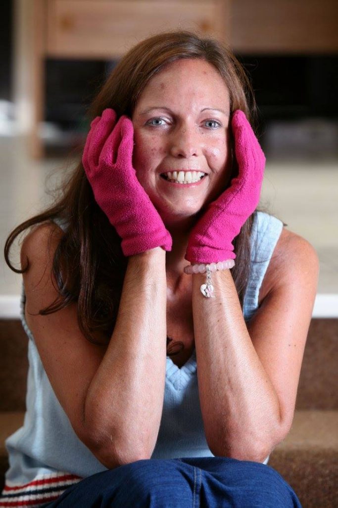 Skin Tests with Scleroderma