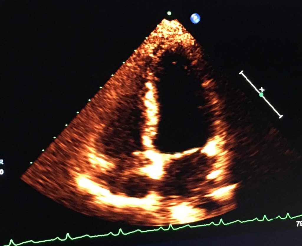 Scleroderma Progression Is Monitored by These Important Tests